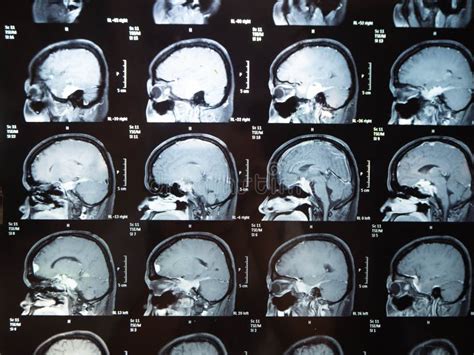 Film X Ray Brain Tumor My Mather Bangkokthailand Stock Illustration