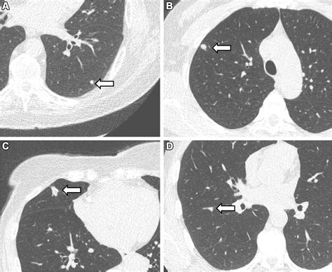 Distribution Of Solid Lung Nodules Presence And Size By Age And Sex In