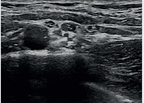 Supraclavicular Us Diagram Quizlet