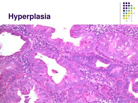 Ppt Endometrial Cancer Powerpoint Presentation Free Download Id