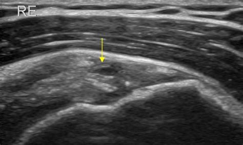 Musculoskeletal Joints And Tendons 61 Shoulder Case 618 Rotator