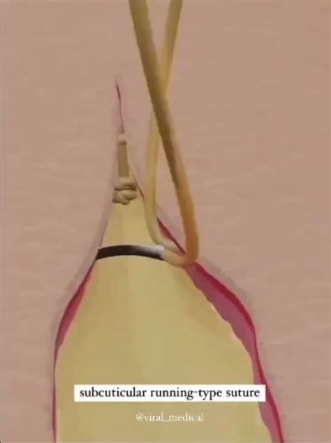 Subcuticular Suture