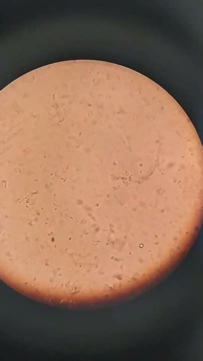 Pyospermia In Semen Analysis Youtube