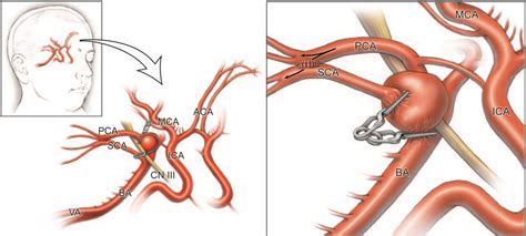Superior Cerebellar Artery Posterior Cerebral Artery Bypass Neurosurgery Blog