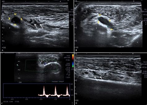 Ultrasound Scans Of Tibio Fibular Proximal Recess And Fibular Nerve Download Scientific Diagram