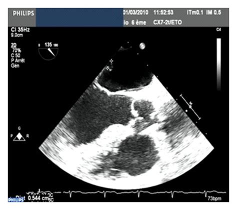 Measurement Of Two Masses In Left Atrium Download Scientific Diagram