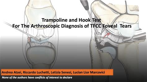 Video 11 2 Arthroscopic Tfcc Testing By Trampoline And Hook Tests On Vimeo