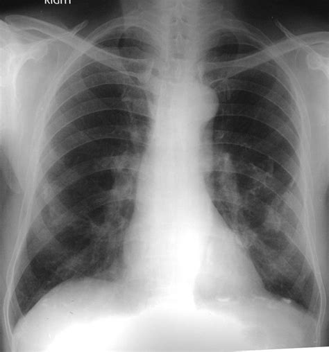 Interstitial Lung Disease X Ray