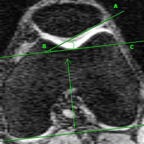 Sulcus Angle Defined As The Angle Formed Between Lines Joining The Download Scientific Diagram