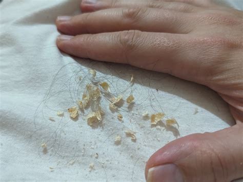 Seborrheic Dermatitis Rdandruff