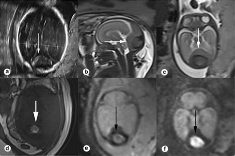 Fetus At 26 3 Gw With Dural Sinus Malformation A The Axial Sonogram Download Scientific