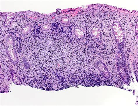 Pathology Outlines Sexually Transmitted Infectious Colitis Proctitis