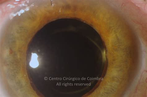 Glaucome NÉovasculaire Atlas Rl Eye
