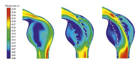 Flow Velocity Distribution Of Cerebral Aneurysm Download Scientific