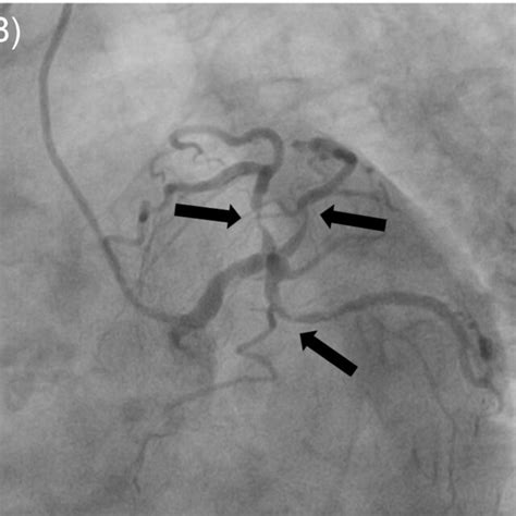 Coronary Artery Angiographic Images Showing Multivessel Disease With A