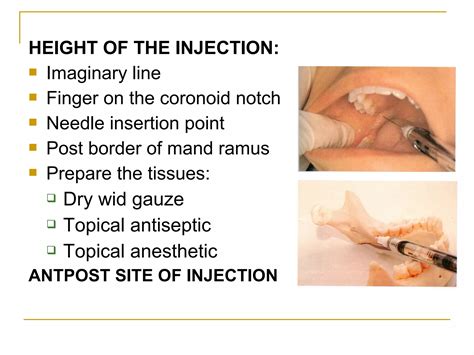 Mandibular Injection Technique Ppt