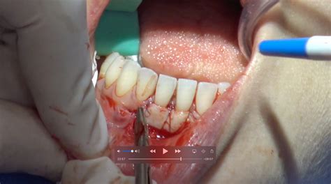 Root Coverage Procedure Using Free Gingival Graft And Arf