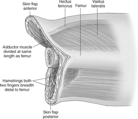 Major Lower Extremity Amputation Basicmedical Key