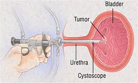 Bladder Cancer Surgery