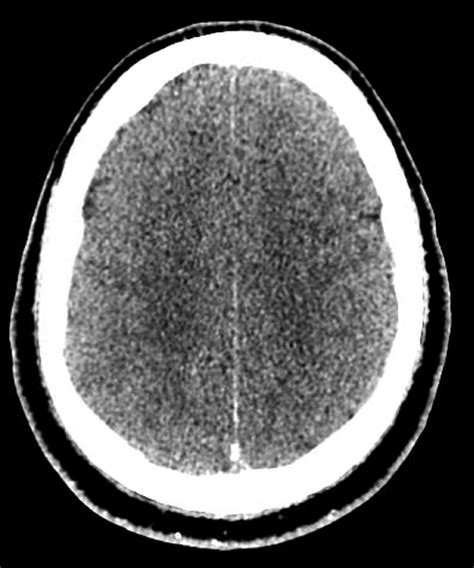 Ct Head Non Contrast Axial Image There Is Cerebral Sulcal
