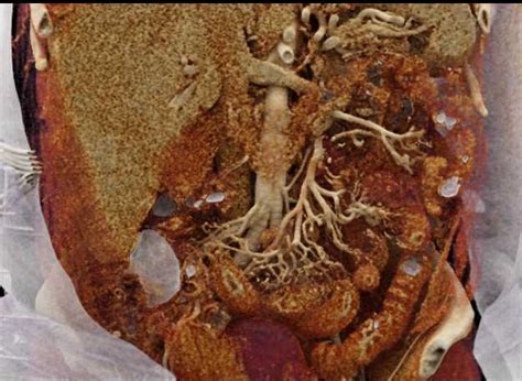 Small Bowel Ischemia Small Bowel Radiology Case Studies Ctisus Ct