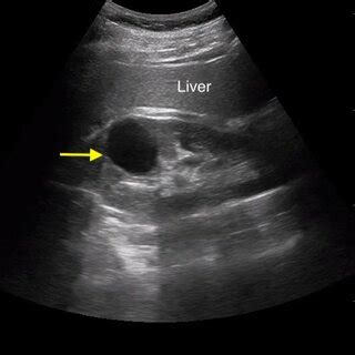 Junctional Parenchymal Defect Yellow Arrow Video S7 Can Be Found In