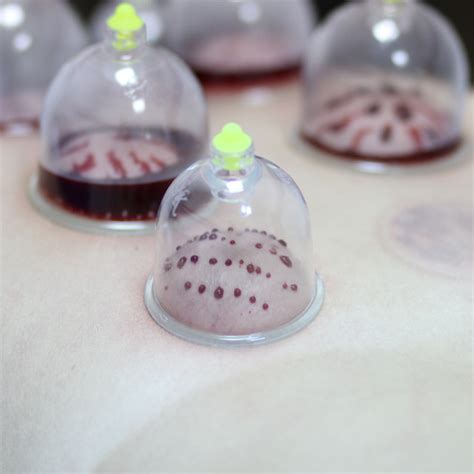 Hidžama Postupak Koji Omogućava Detoksikaciju Organizma