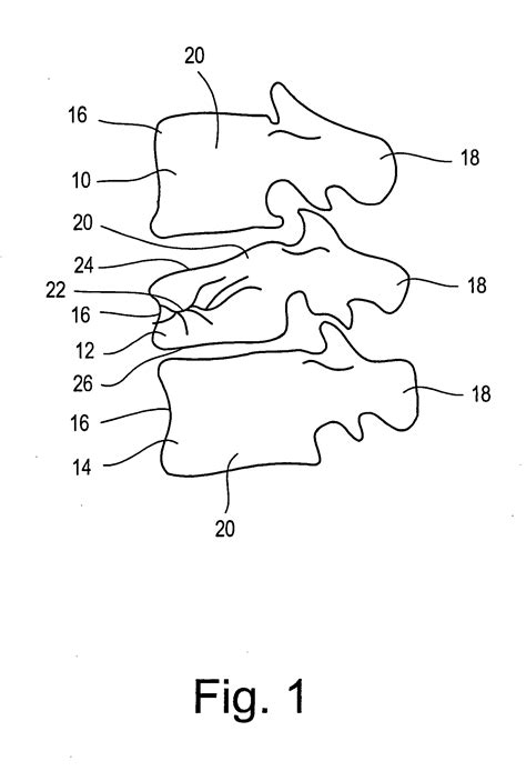 Vertebra Compression Fracture Patented Technology Retrieval Search Vertebra Compression Fracture Patented Technology Retrieval Search
