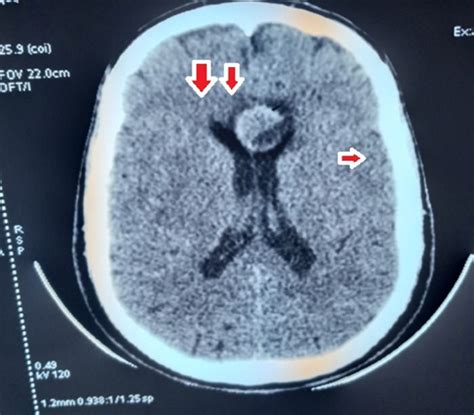 Areas Of Temporal And Insular Hypodensity Download Scientific Diagram