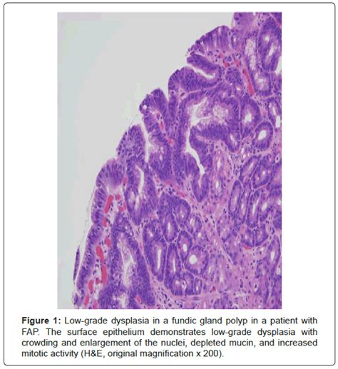 Gastrointestinal Digestive System Low Grade