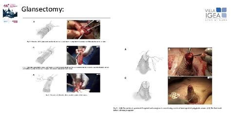 Tumore Dellapparato Riproduttivo Maschile Best Papers Sul Tumore