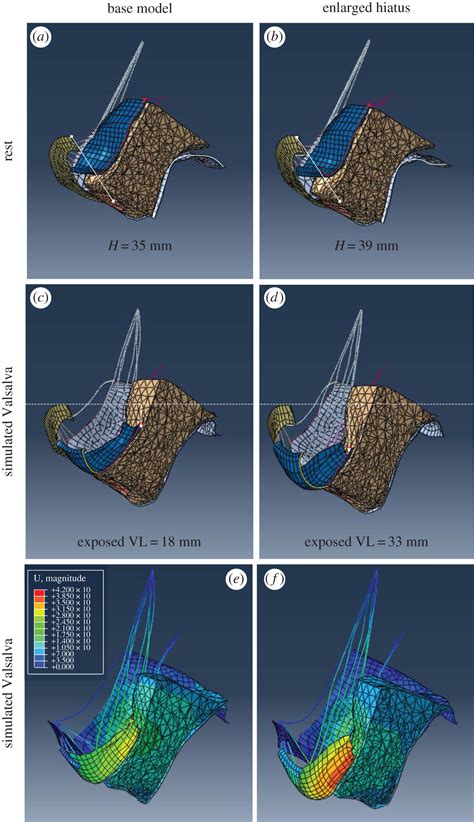 Development Of Anatomically Based Customizable Three Dimensional Finite Element Model Of Pelvic