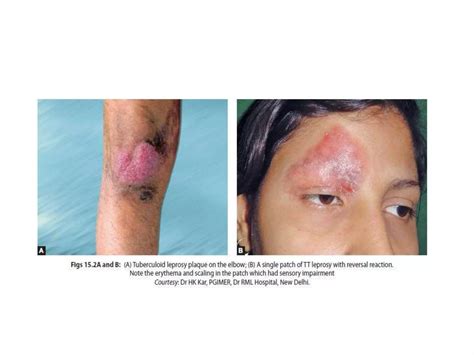 Cutaneous Lesions In Leprosy Pptx