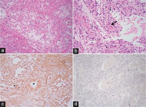 Specimen Resected At Surgery Demonstrating A Piloid Tumor Cells