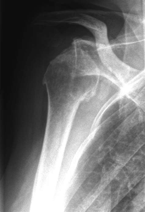 Reverse Arthroplasty For Patients With Chronic Locked Dislocation Of
