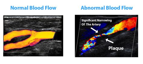 Carotid Doppler Early Detection Of Arterial Diseases