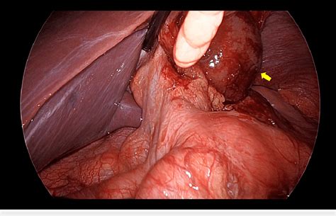 Intraoperative View Of The Gallbladder Volvulus That Displaced To The