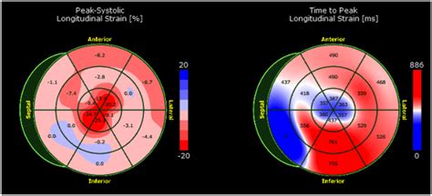 Classic Example Of Reduced Global Longitudinal Strain With Apical