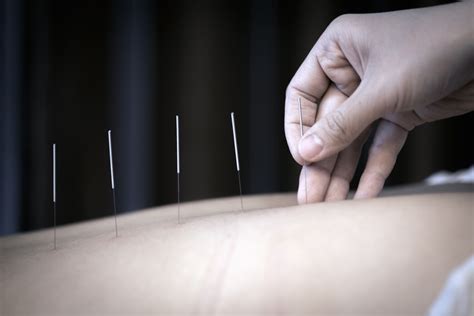 Understanding The Difference Between Dry Needling And Acupuncture