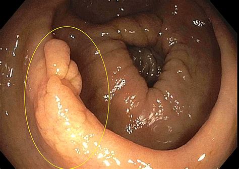 Slightly Nodular Mucosa In The Transverse Colon Download Scientific Diagram