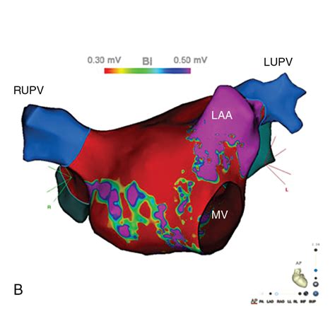 Electroanatomic Mapping And Magnetic Guidance Systems Thoracic Key