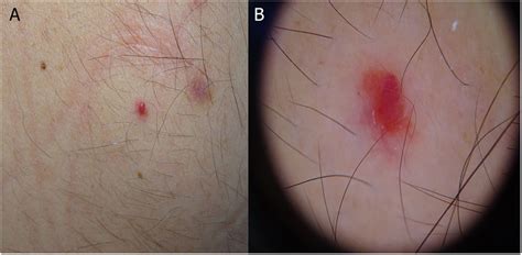 Glomeruloid Hemangioma Leading To A Diagnosis Of Poems Syndrome
