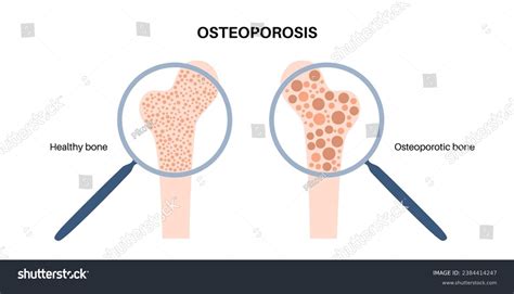 Osteoporosis Disease Poster Systemic Skeletal Disorder Stock Vector
