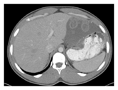 Computed Tomography Ct Image Demonstrating The Appearance Of Gastric