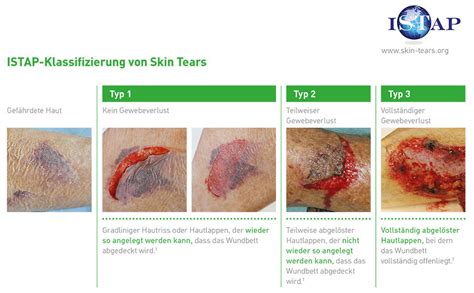 Skin Tears Einrisse Fragiler Haut Erkennen