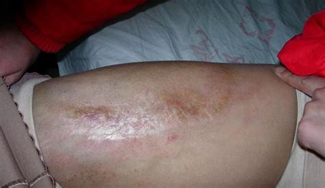 硬皮病的症状图片 硬皮病图片大全 硬皮病 39疾病百科