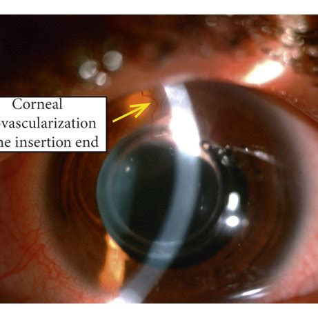 Neovascularization Of The Cornea At The Insertion End Of The 355 Degree