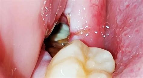 Normal Socket After Tooth Extraction With Pictures 2023 Go Fix Teeth
