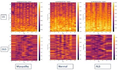 Emg Signal Classification For Neuromuscular Disorders With Attention
