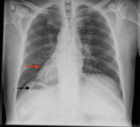 Chest X Ray Shows Dextrocardia Red Arrow And Gastric Bubble Black Download Scientific